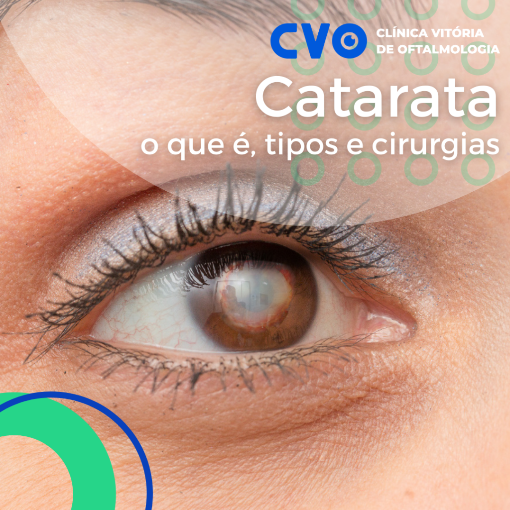 Você sabe o que é a catarata? - CLÍNICA VITÓRIA